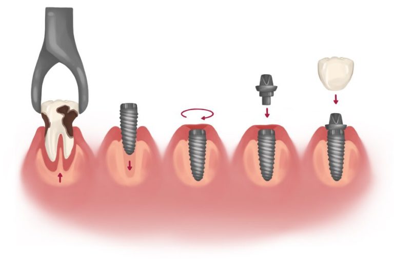 Step-By-Step Dental Implant Procedure: What to Expect